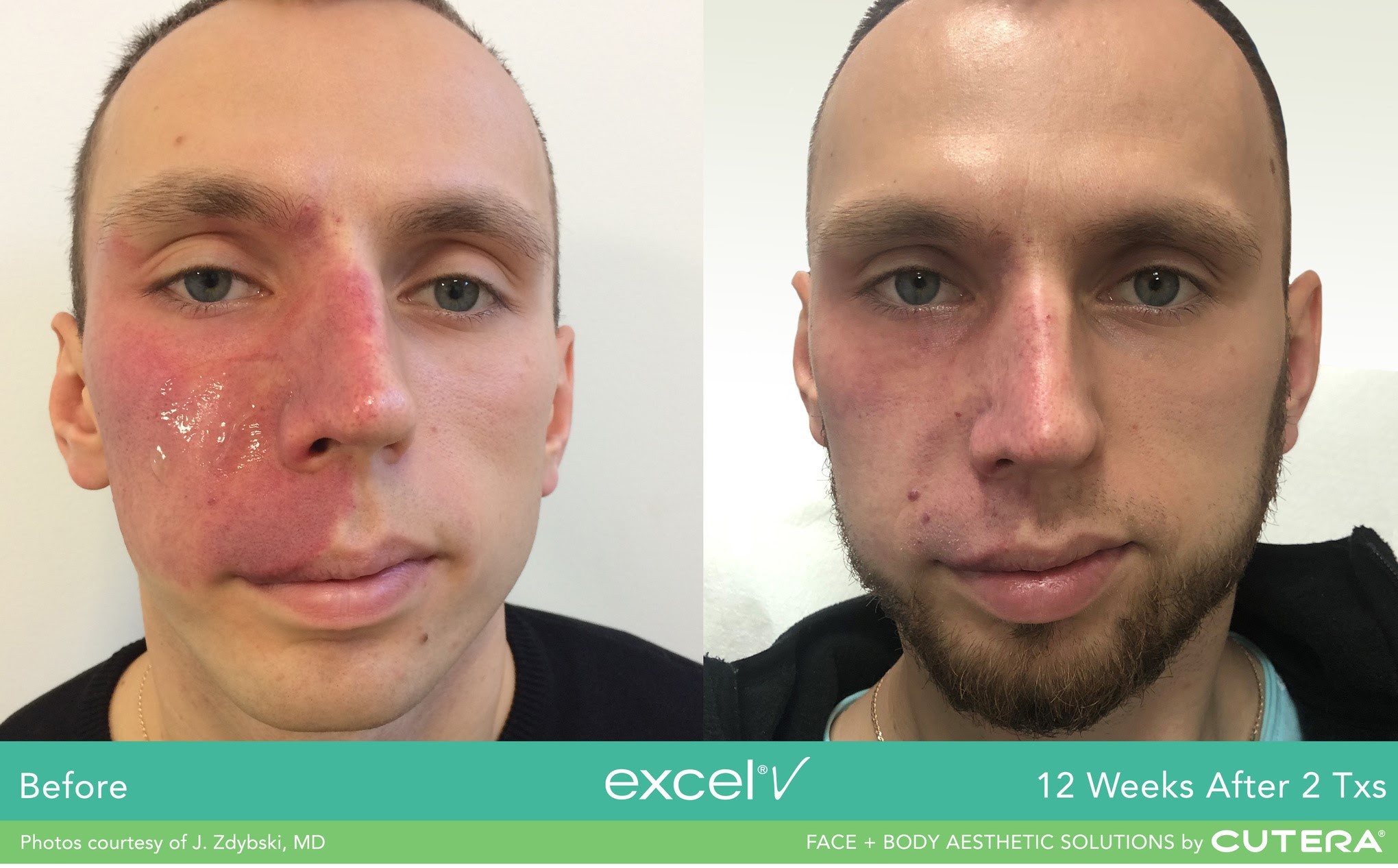 Excel V+ Laser Genesis Treatment | Erina Skin Cancer Clinic